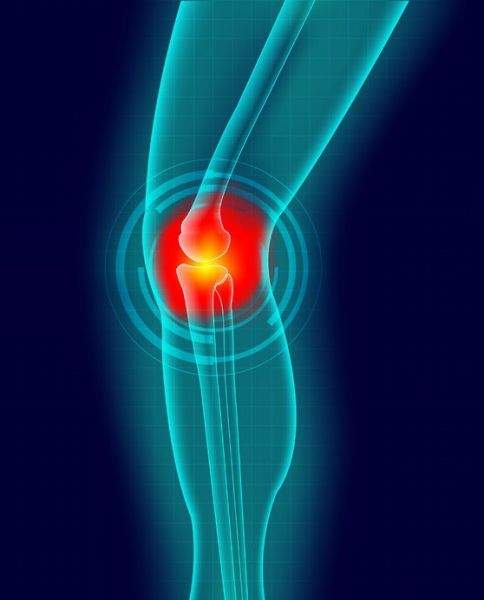 Artróza | liečba | príznaky - Schneider MBST